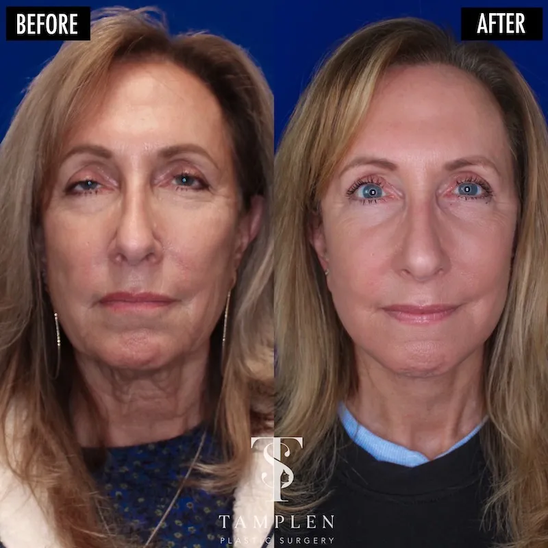 Tamplen Plastic Surgery – Scottsdale, AZ | Orinda, CA | San Diego, CA